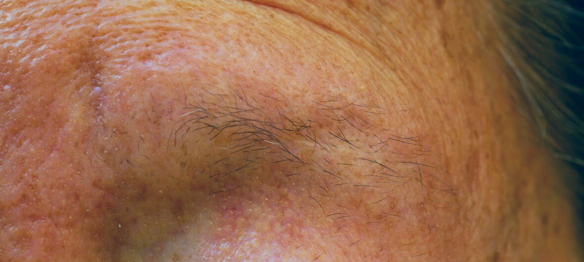 The Lowdown on Male Eyebrow Hair Loss: Causes and Solutions