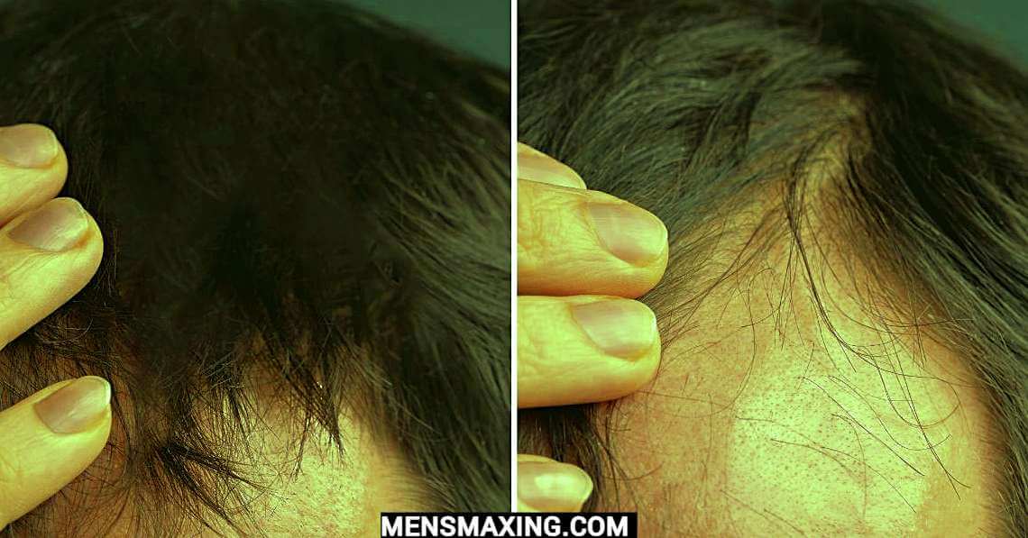 Hair Transplant Explained: Everything You Need to Know